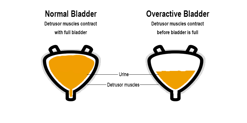 Overactive Bladder Treatment in Meerut by Dr. Subhash Yadav
